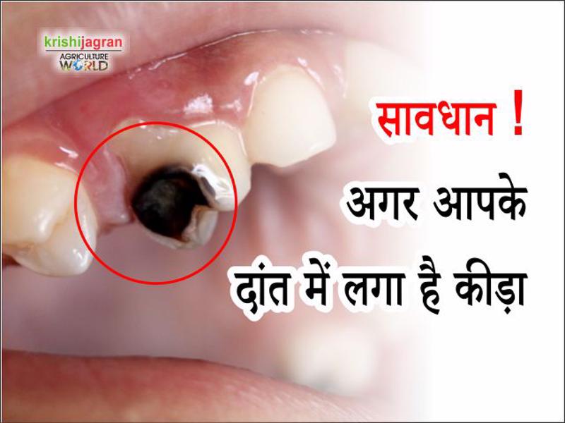 Tooth Worm Problem : दांतों के कीड़ों को न करे नजरअंदाज, अपनाए ये घरेलू ...